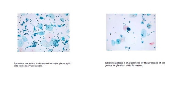 Liquid based cytology pathology CYTOLOGY.pptx