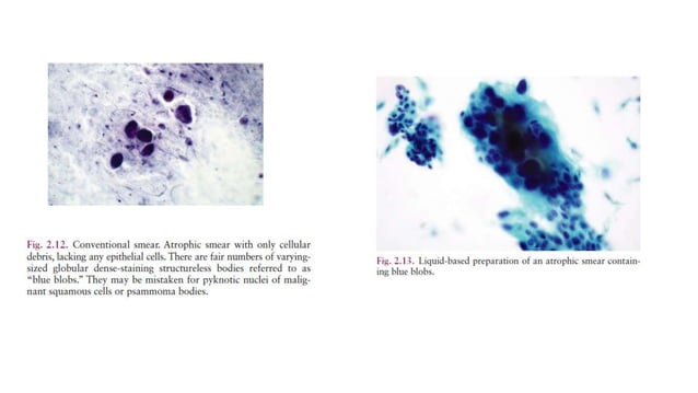 Liquid based cytology pathology CYTOLOGY.pptx