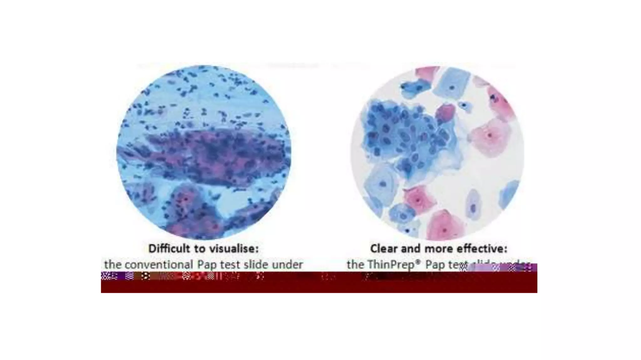 Liquid based cytology | Abdul Quddus | PPTX