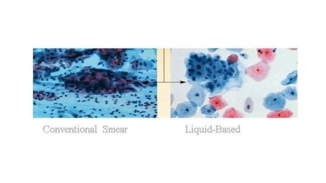 Liquid based cytology | Abdul Quddus | PPTX