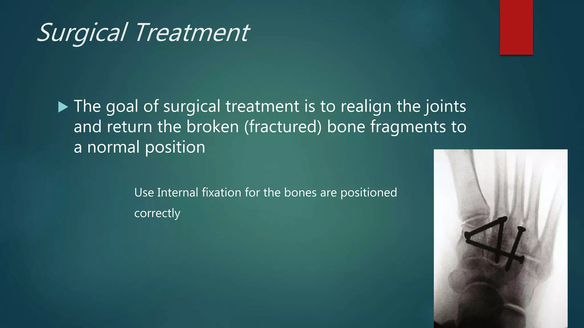 Lisfranc injury | PPTX
