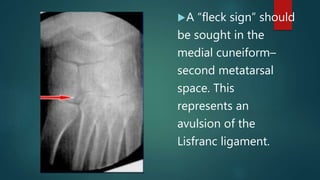 Lisfranc injury | PPTX