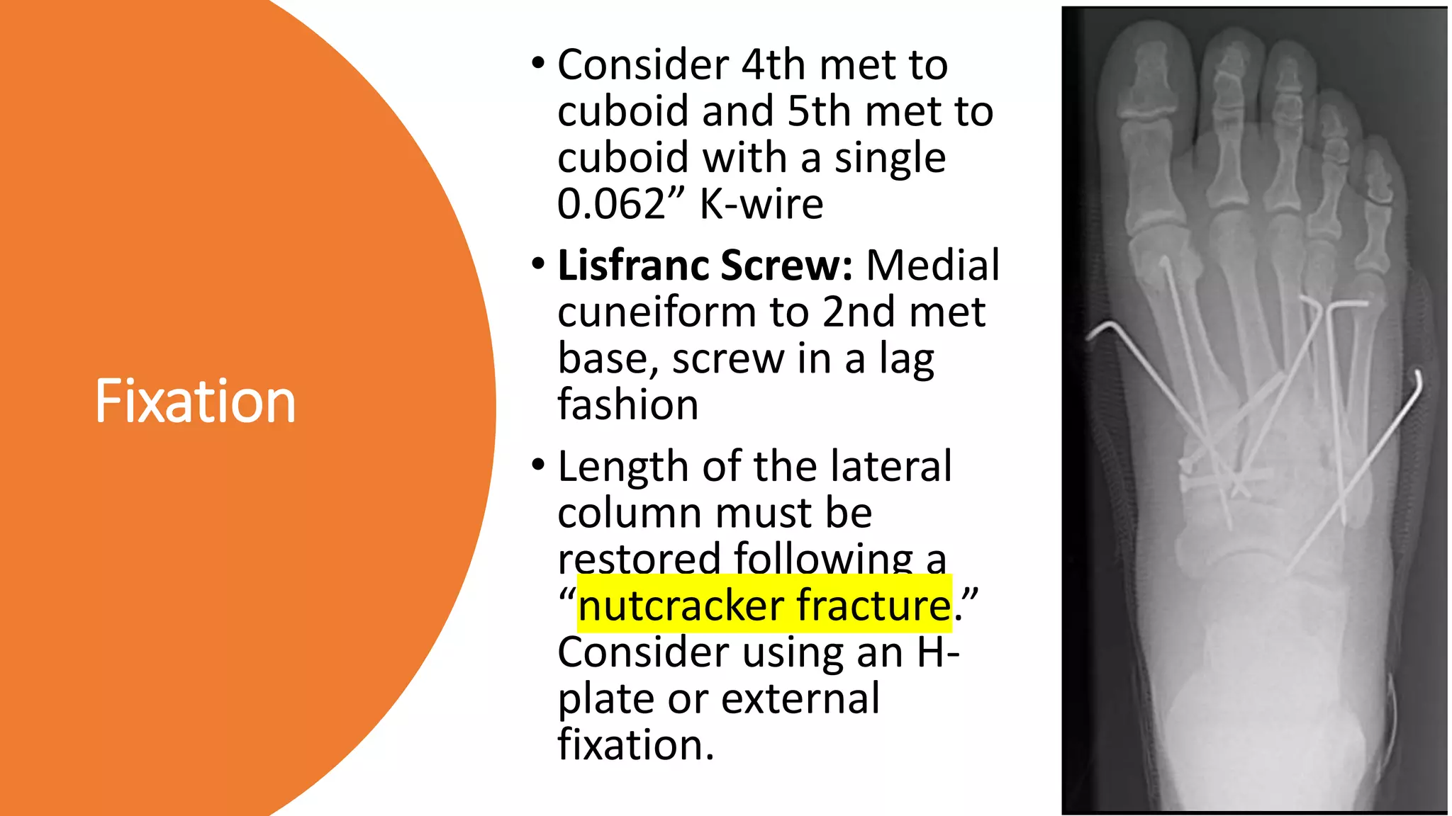 AJM Sheet: Lisfranc Trauma | PPTX