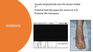 AJM Sheet: Lisfranc Trauma | PPTX