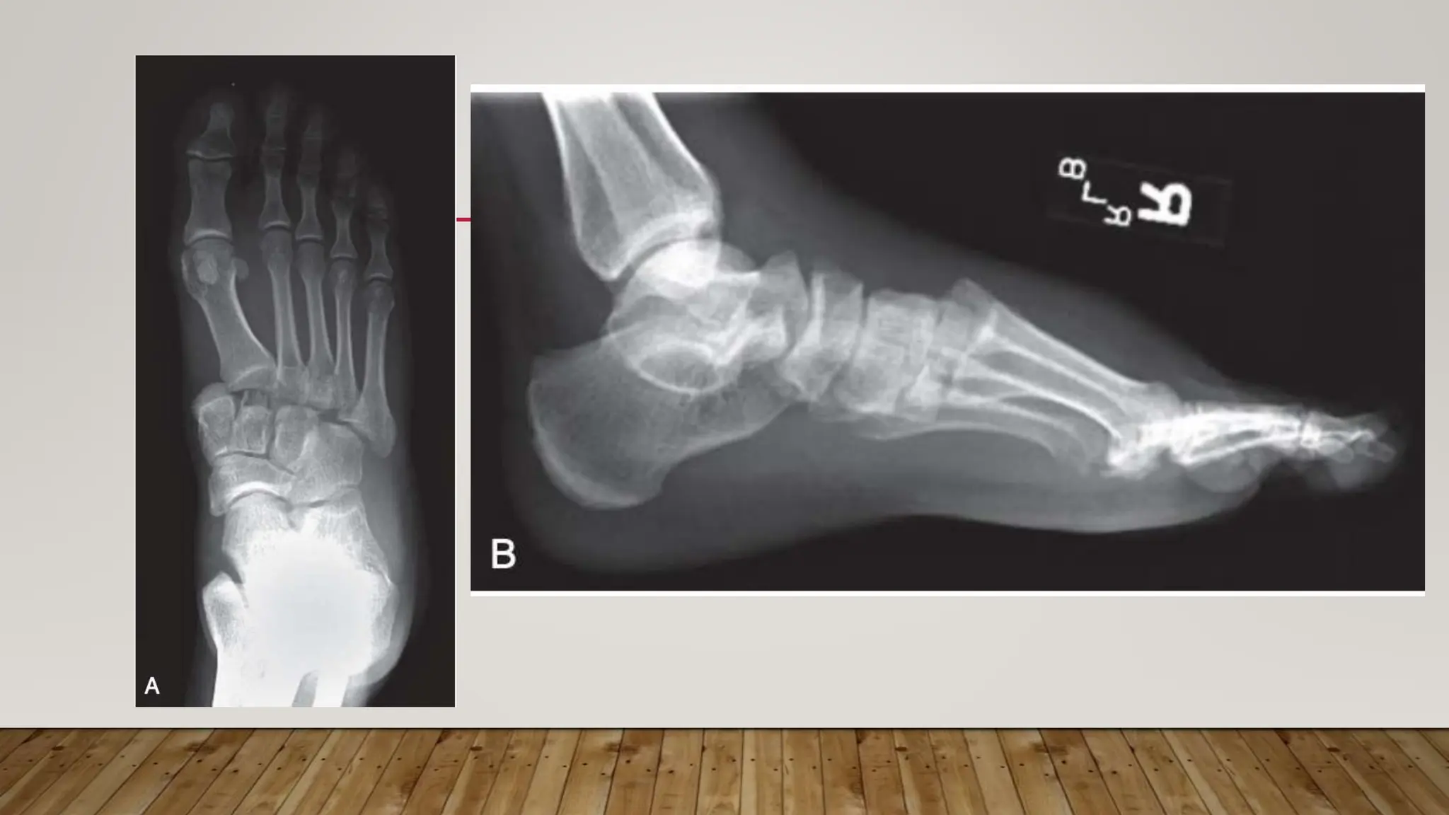 Lisfranc fracture of lower extrimities.pptx