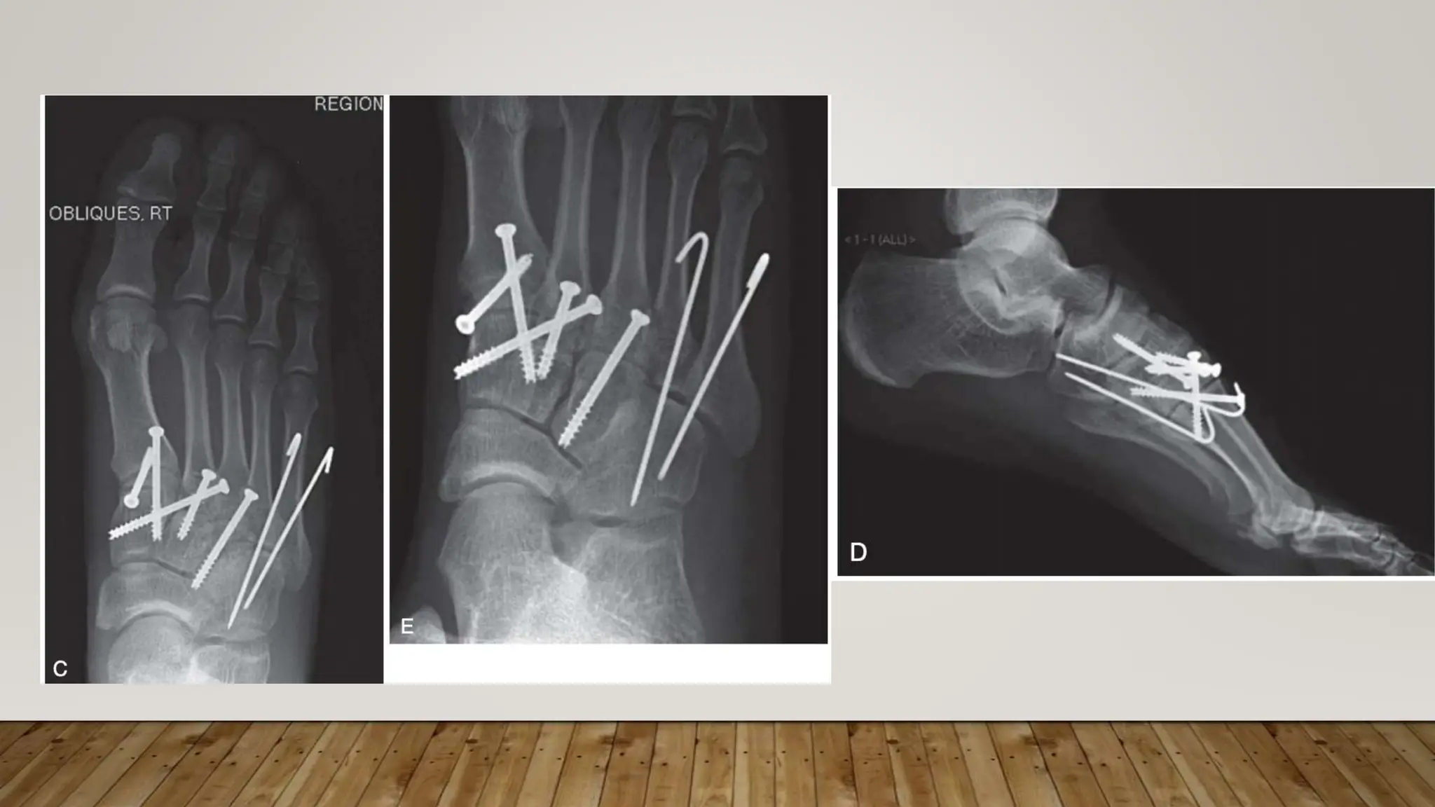 Lisfranc fracture of lower extrimities.pptx