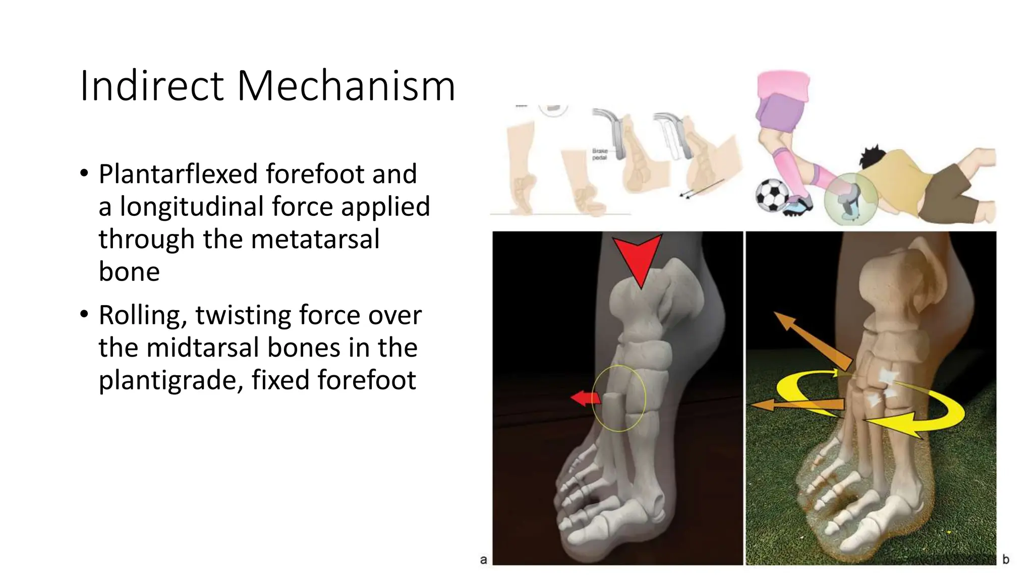 Lisfranc and Forefoot fracture in adult.pptx