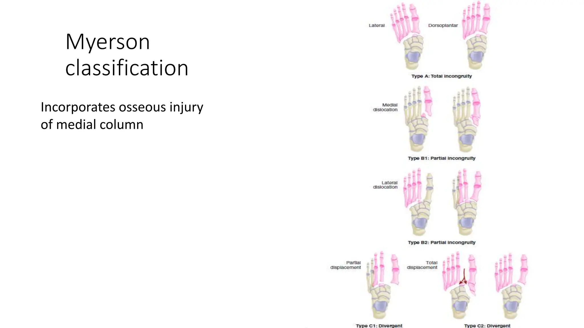 Lisfranc and Forefoot fracture in adult.pptx