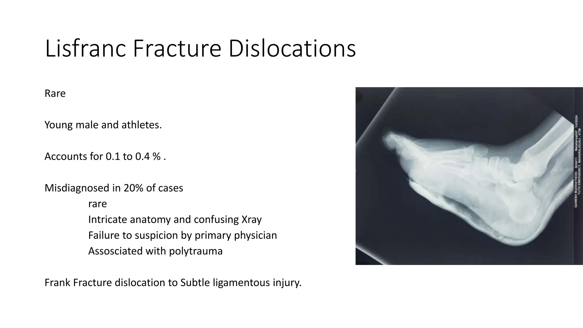 Lisfranc and Forefoot fracture in adult.pptx