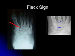 Lisfranc fractures | PPT