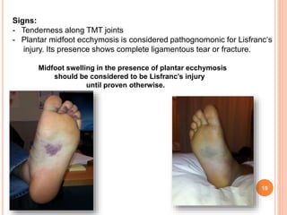 Lisfranc injuries | PPTX