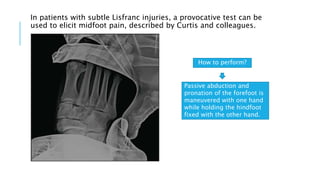 Lisfranc injuries | PPTX