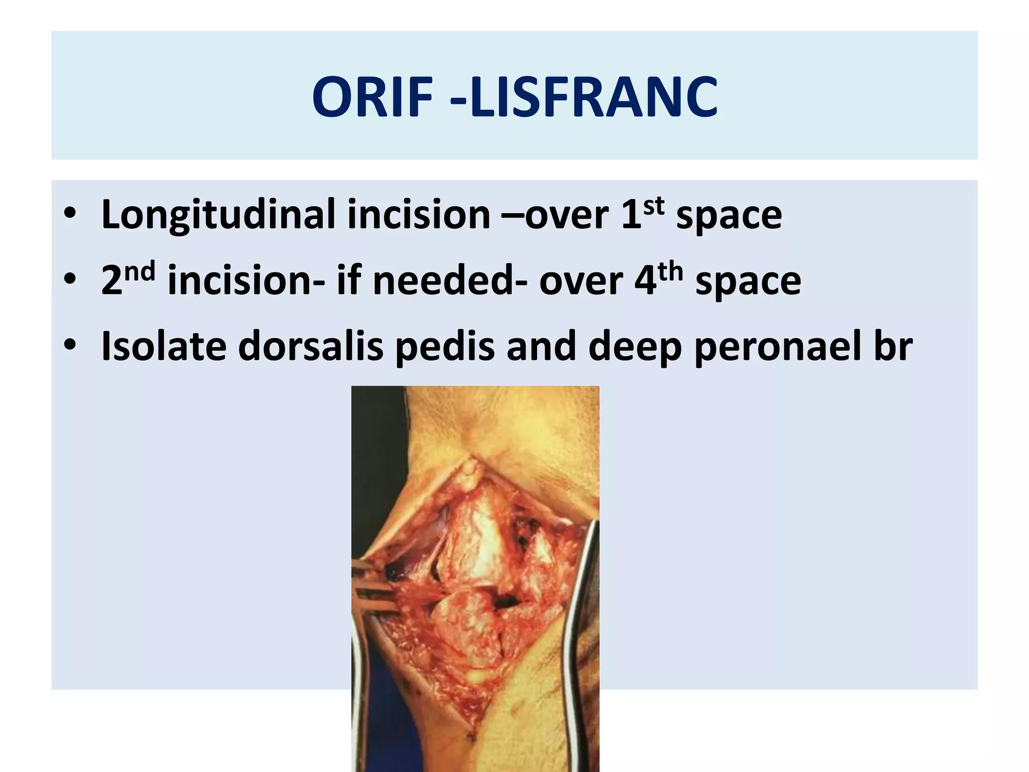Lisfranc injuries -surgical management , dr mohamed ashraf ,HOD ...