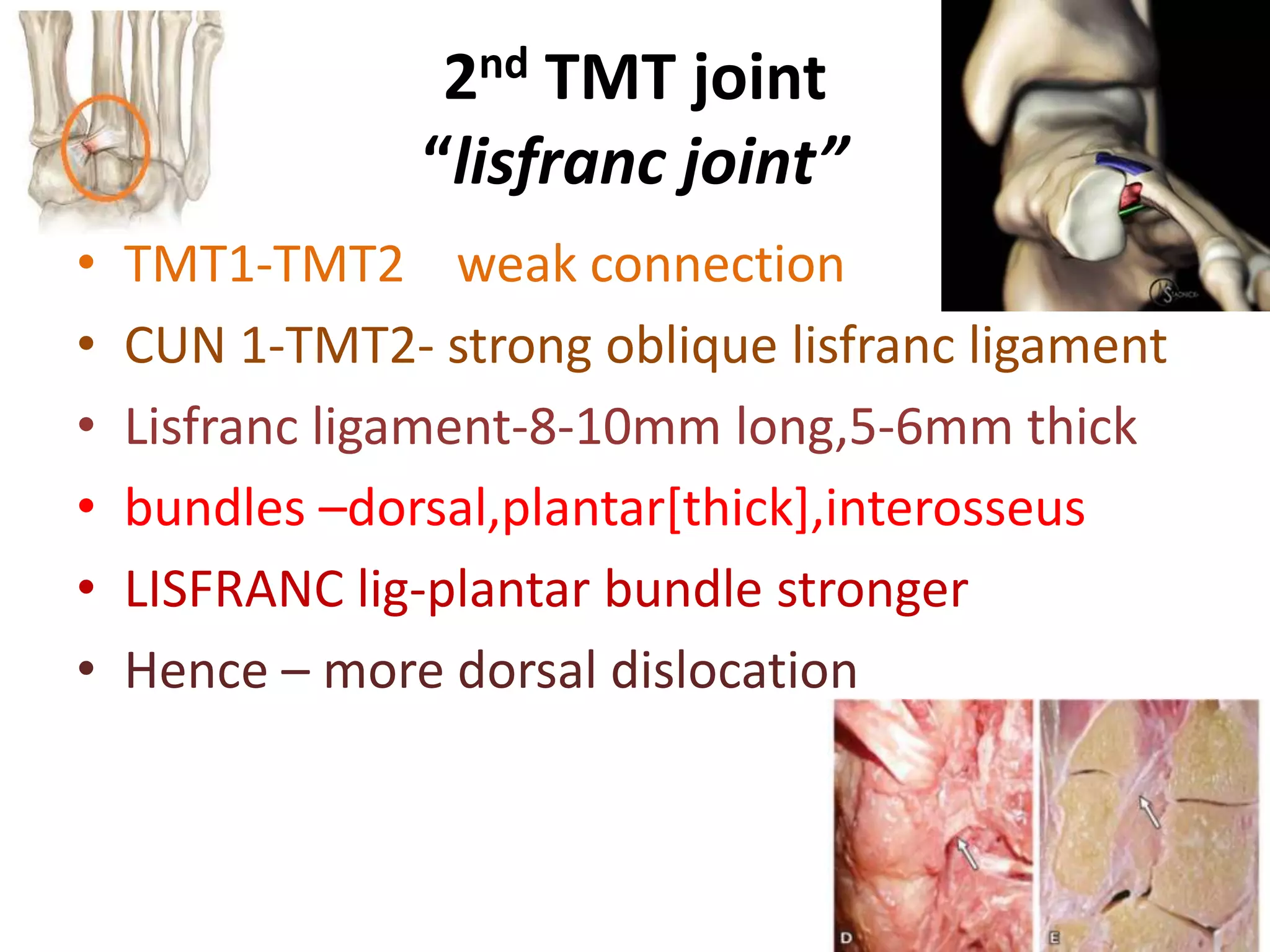 Lisfranc injuries -surgical management , dr mohamed ashraf ,HOD ...