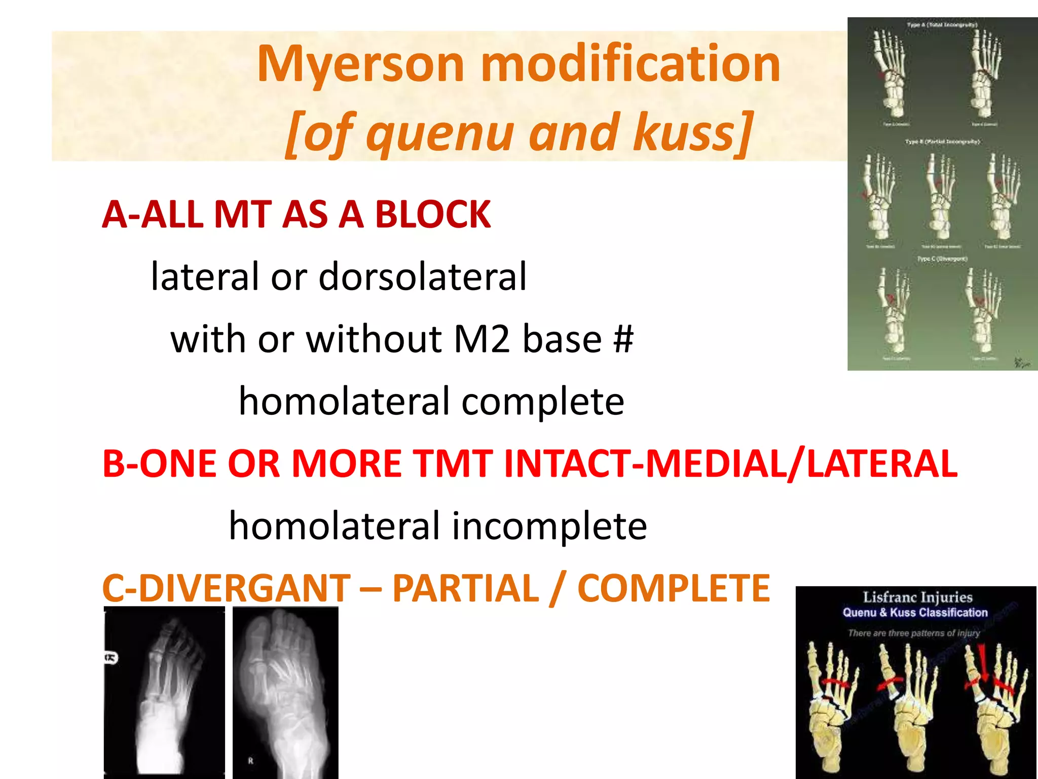 Lisfranc injuries -surgical management , dr mohamed ashraf ,HOD ...