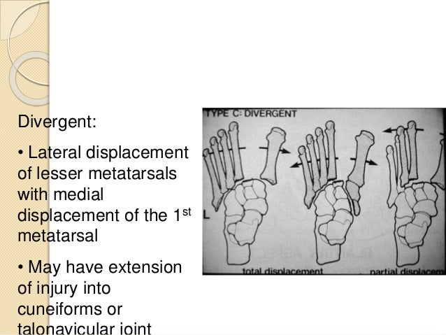 Lisfranc injury
