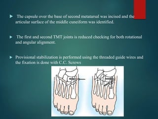 Lisfranc injury | PPTX