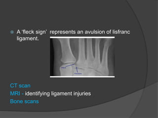 Lisfranc injury | PPTX