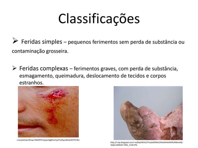 Feridas Traumáticas e Queimaduras | PPTX