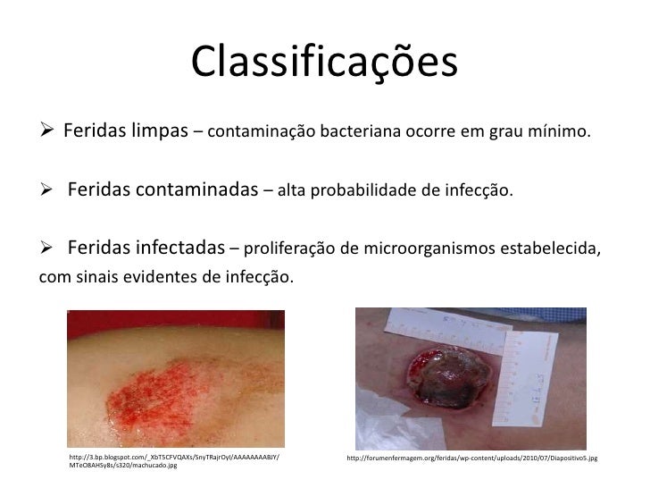 Feridas Traumáticas e Queimaduras