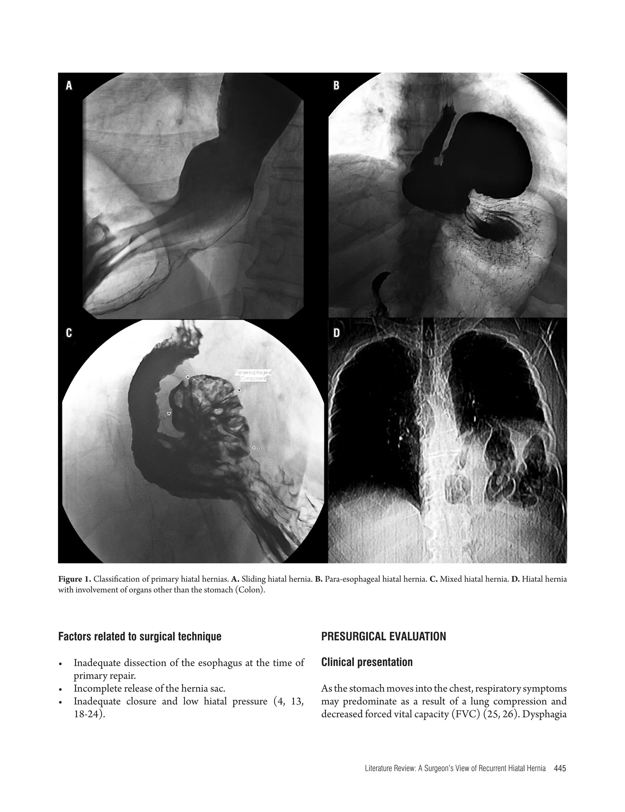 Literature review a surgeon's view of recurrent hiatal hernia | PDF ...