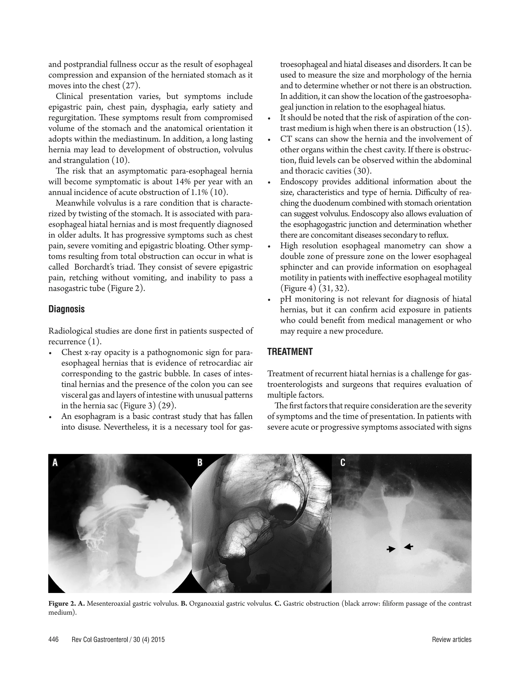 Literature review a surgeon's view of recurrent hiatal hernia | PDF ...