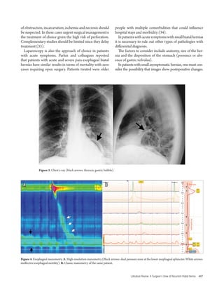 Literature review a surgeon's view of recurrent hiatal hernia | PDF ...