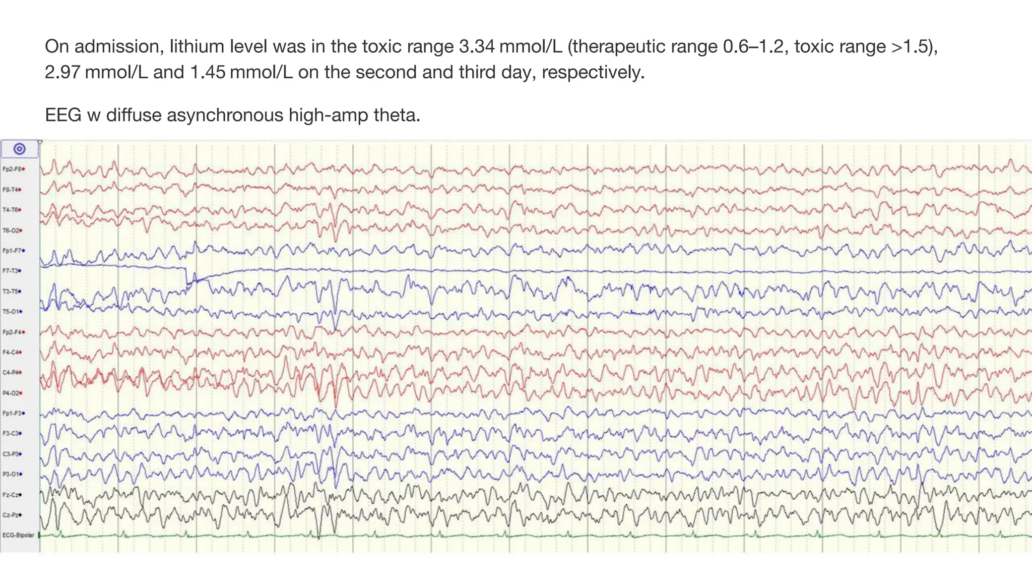 EEG changes associated with lithium use in patients | PPT