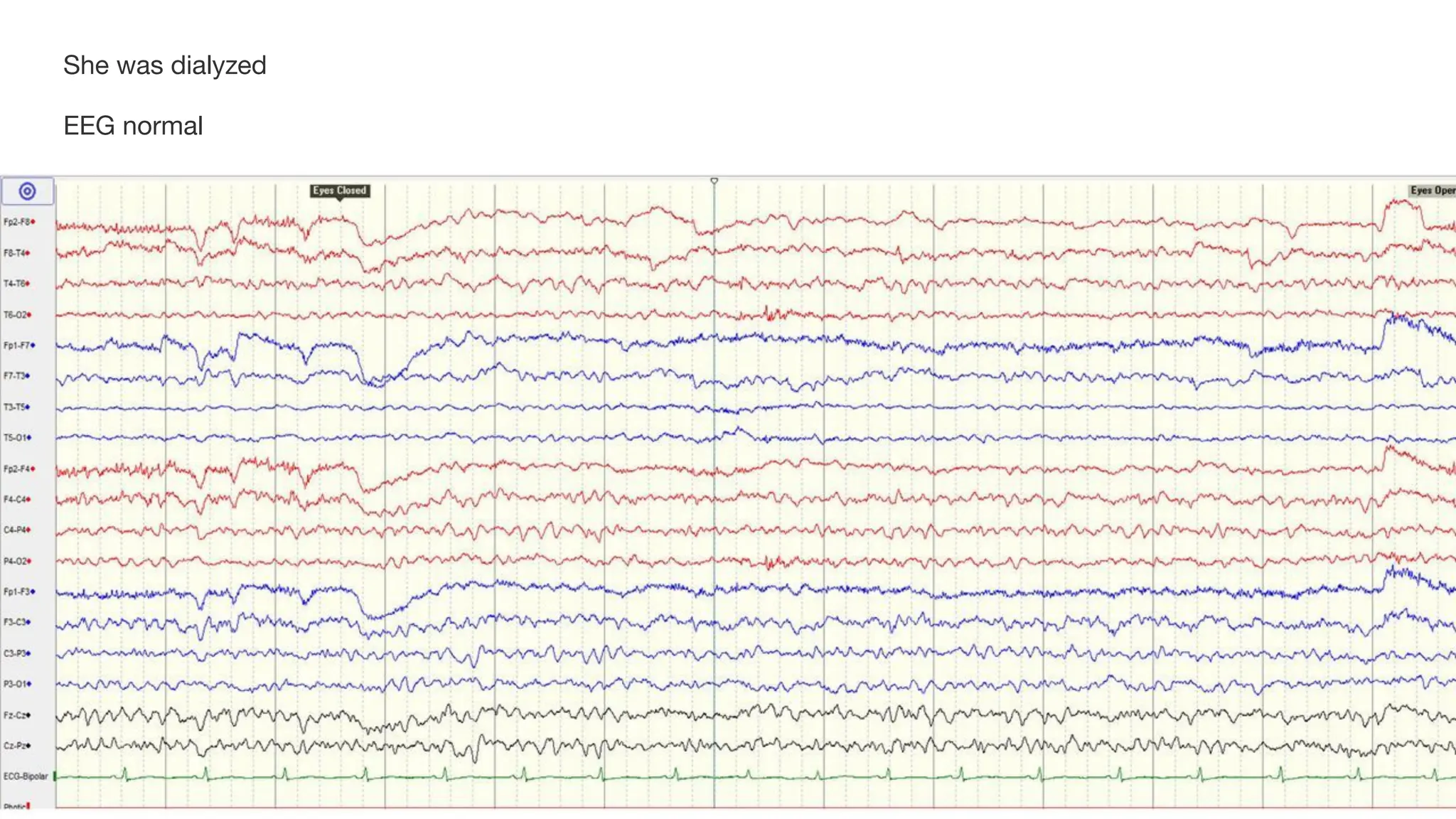 EEG changes associated with lithium use in patients | PPT