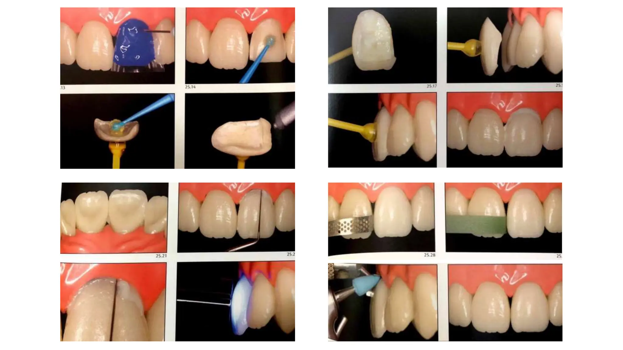 LITHIUM DISILICATE PPT in dentistary non metallic crown | PPTX