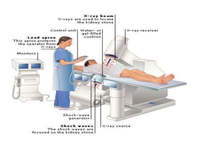 Lithotripter.pptx | Medical Health