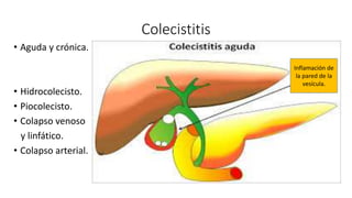 LITIASIS BILIAR. Cólico biliar, Colecistitis Aguda. | PPTX
