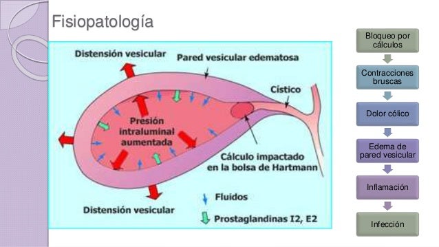 LITIASIS BILIAR. Cólico biliar, Colecistitis Aguda.