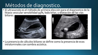 Litiasis biliar | PPTX
