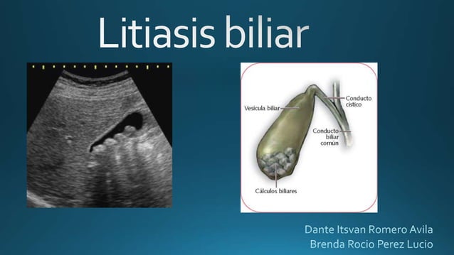 Diagnóstico ultrasonido litiasis vesicular | PPT