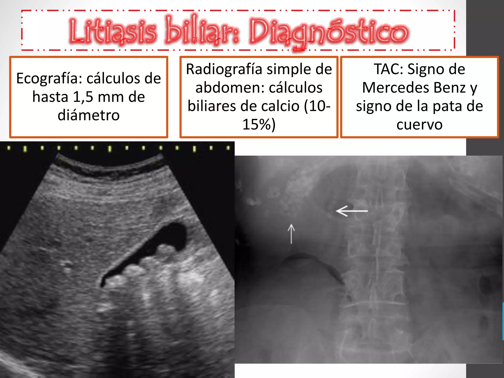 Litiasis biliar, colico biliar, colecistitis aguda | PPT