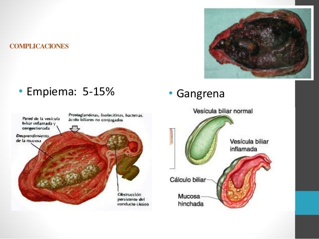 Litiasis biliar, Cólico Biliar y Colecistitis Aguda