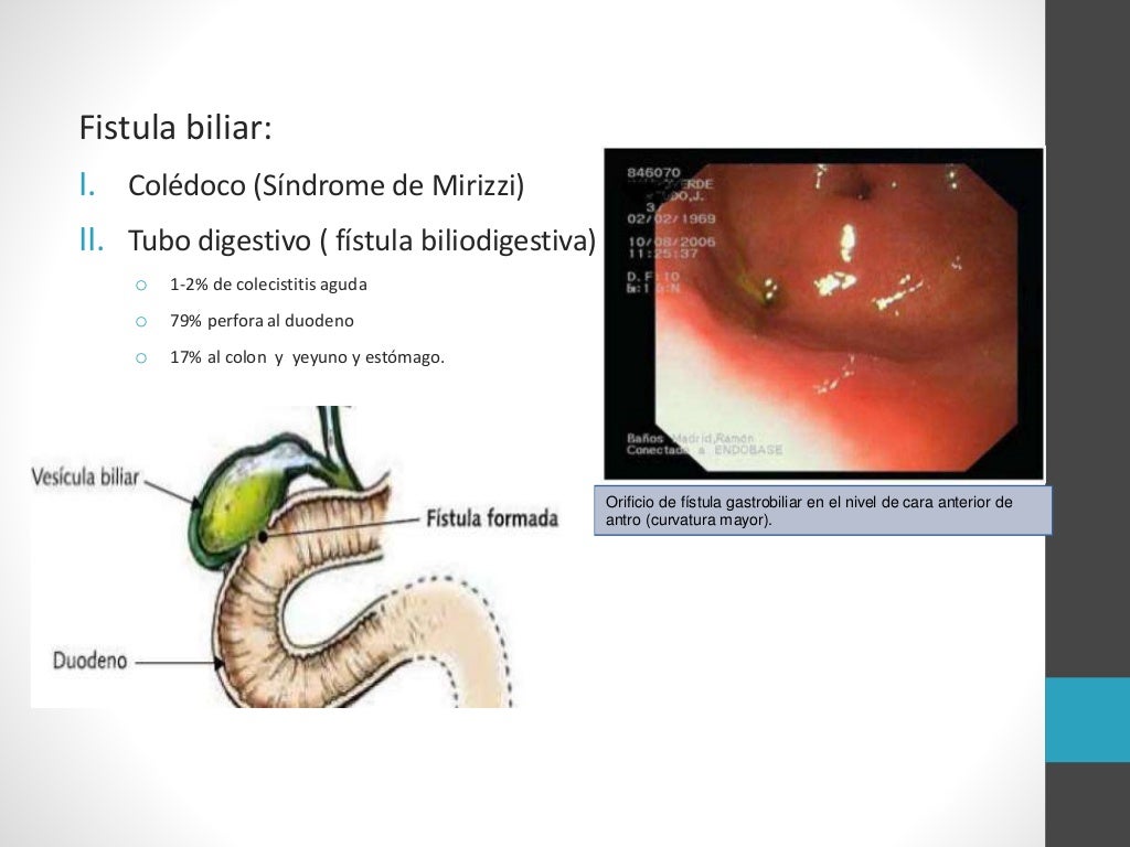 Litiasis Biliar Y Cólicos Biliares » Saludigestivo – FDOMF