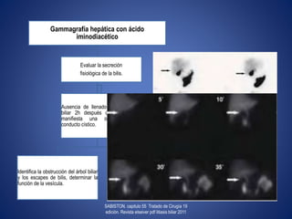 Litiasis biliar y colecistitis aguda. | PPTX