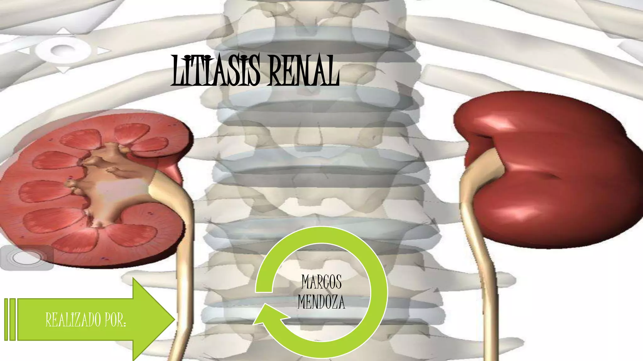 Litiasis renal | PPT