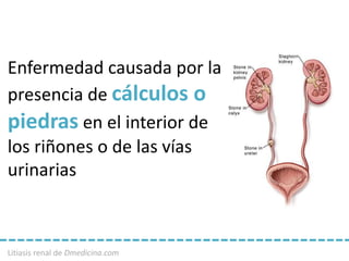 Generalidades de la Litiasis renal | PPTX