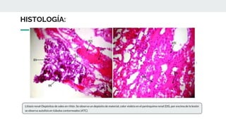 Litiasis Renal.pptx