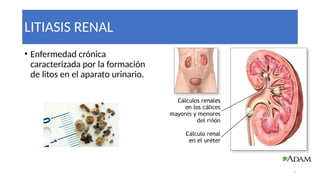 LITIASIS RENAL CAYETANO residentado 2025.pptx