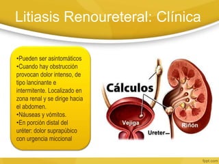 Litiasis renal e infecciones del tracto urinario | PPT