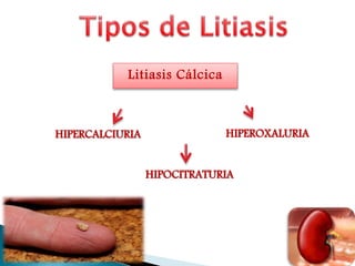 Litiasis renal | PPTX