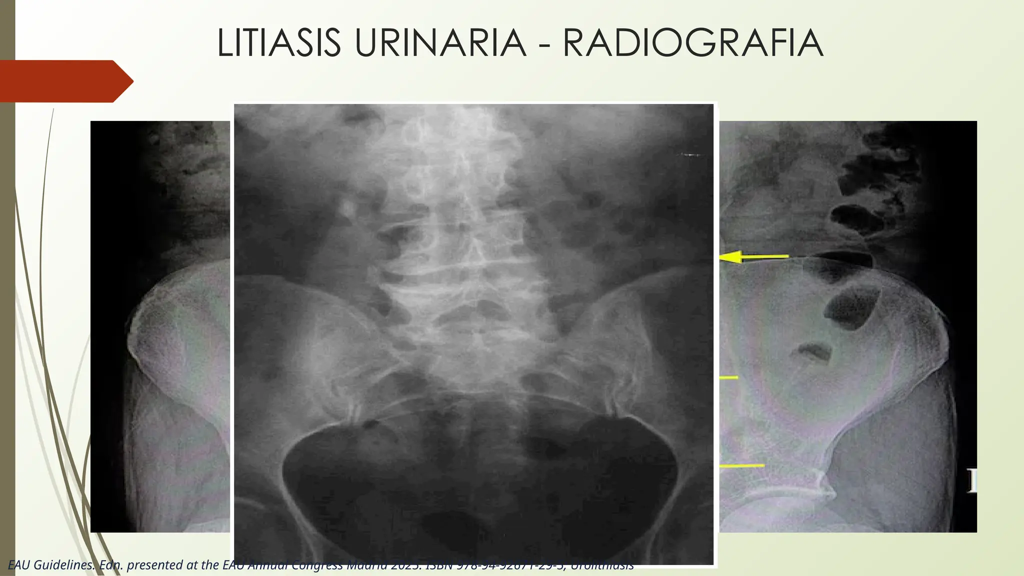 LITIASIS URINARIA. urologia vista por imagenes | PPT