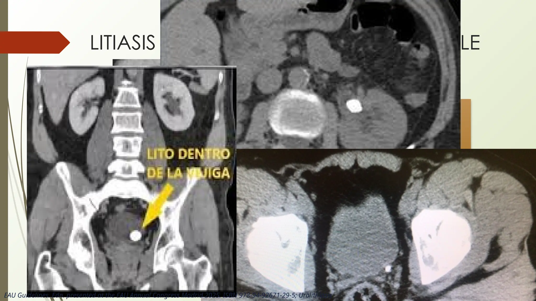 LITIASIS URINARIA. urologia vista por imagenes | PPT