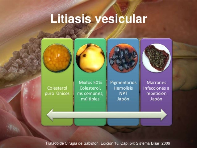 Litiasis Vesicular