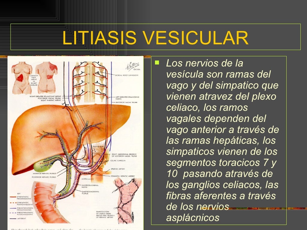 Litiasis vesicular