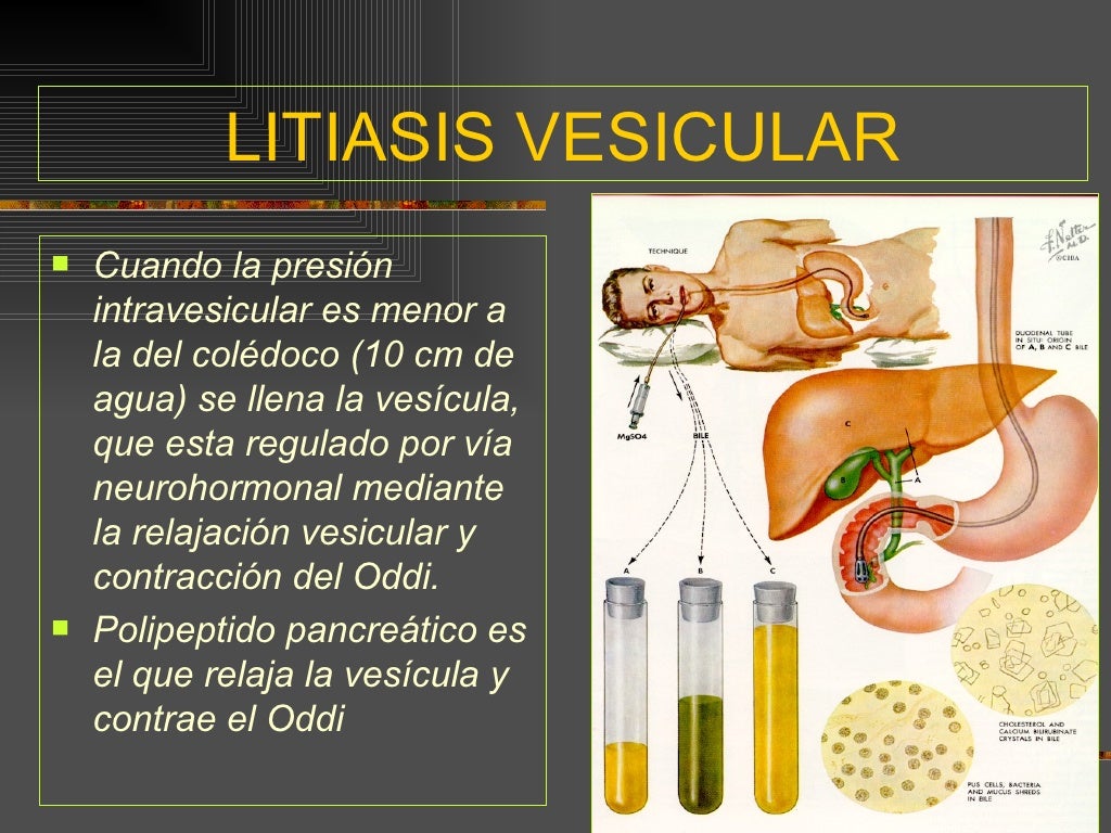 Litiasis vesicular